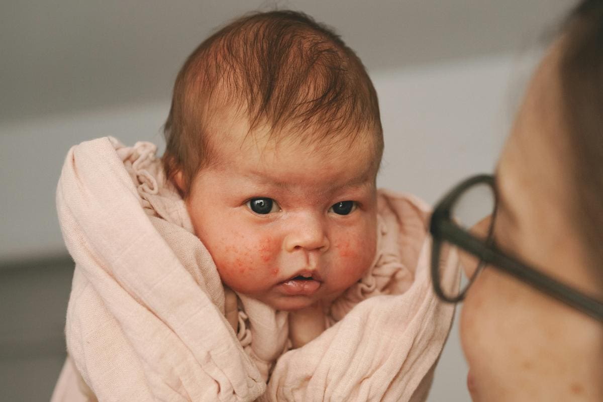 Common Baby Rashes and What to Do About Them